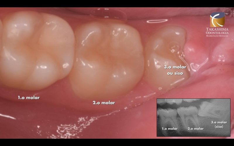 Como funciona a extração dos sisos? - Dr Marcos Takashima